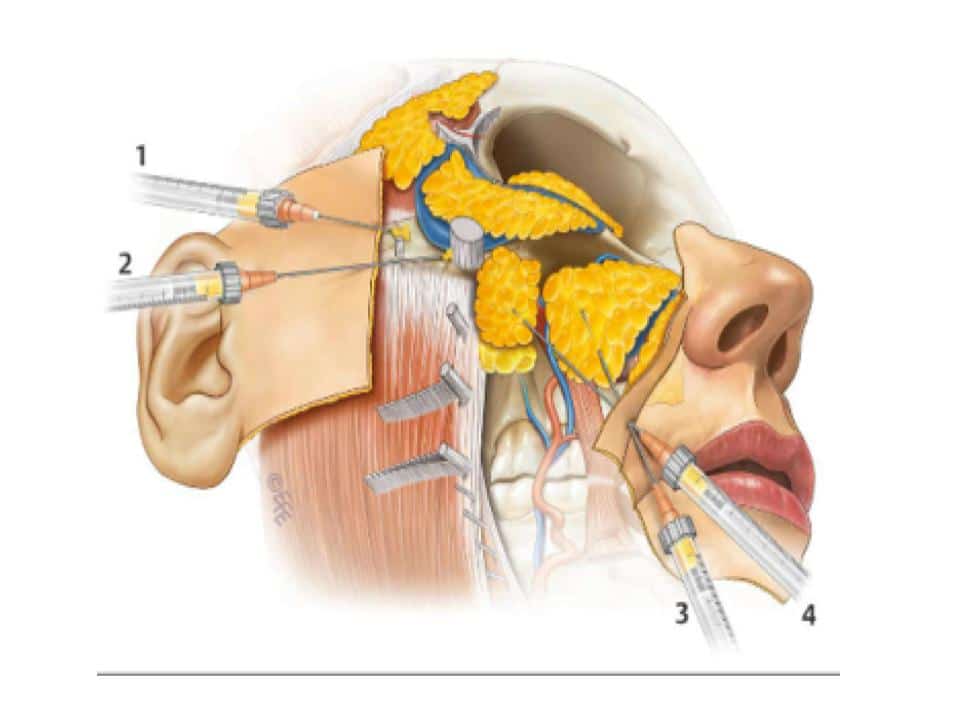 Non-Surgical Facelift Using Fillers|Vanity Cosmetic Clinic,Andheri,Mumbai