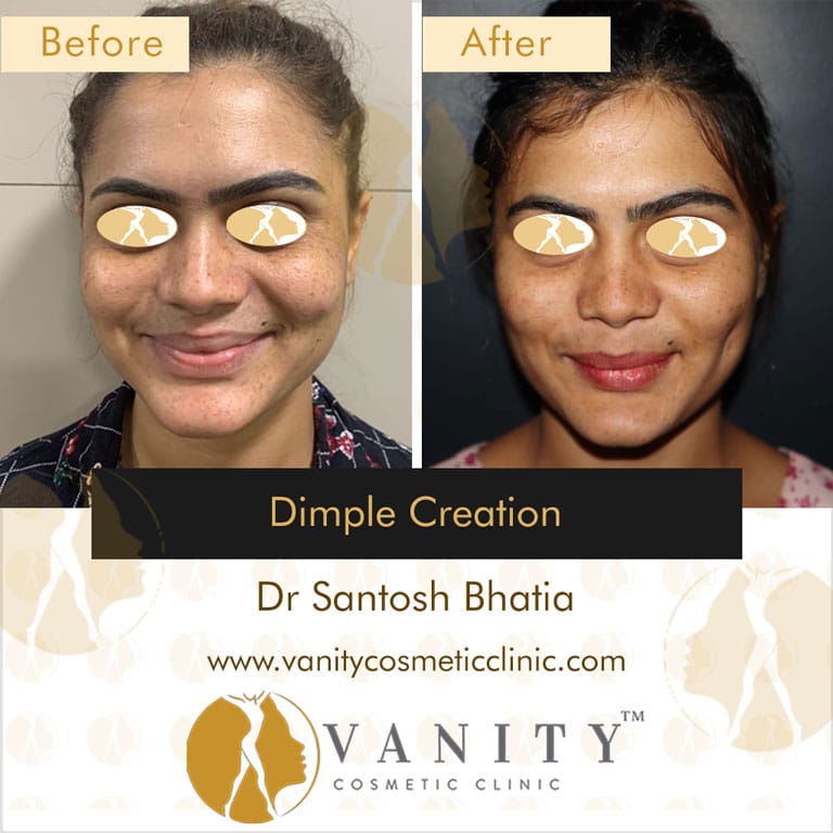 Dimpleplasty: Cost & Process | Vanity Cosmetic Clinic, Andheri, Mumbai